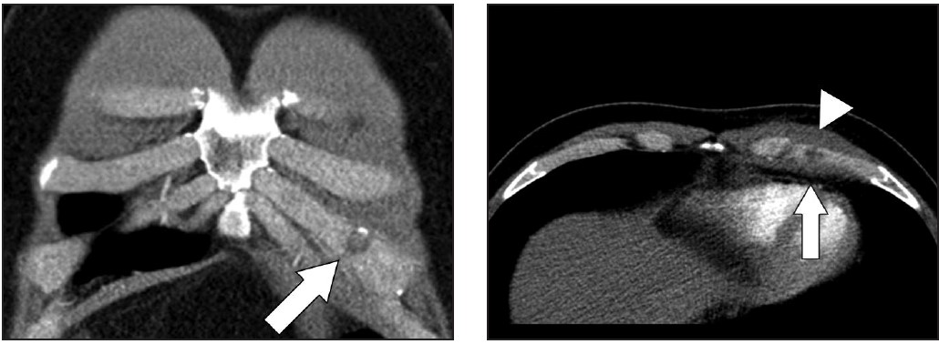 Musculoskeletal Imaging of Chest Wall Injuries in Athletes – American ...