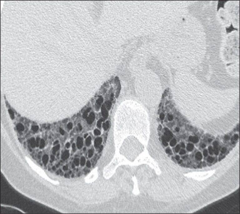 Diagnosing Interstitial Lung Disease – American Roentgen Ray Society