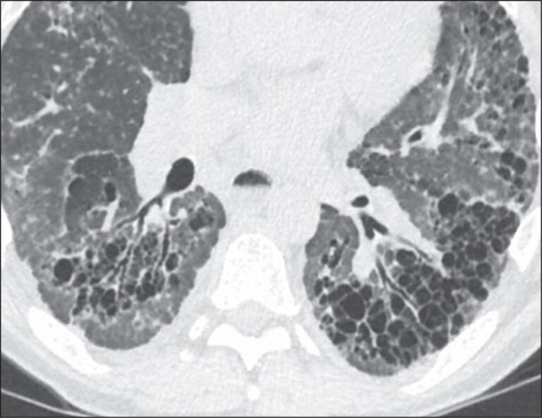 Diagnosing Interstitial Lung Disease – American Roentgen Ray Society