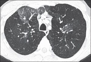 Diagnosing Interstitial Lung Disease – American Roentgen Ray Society